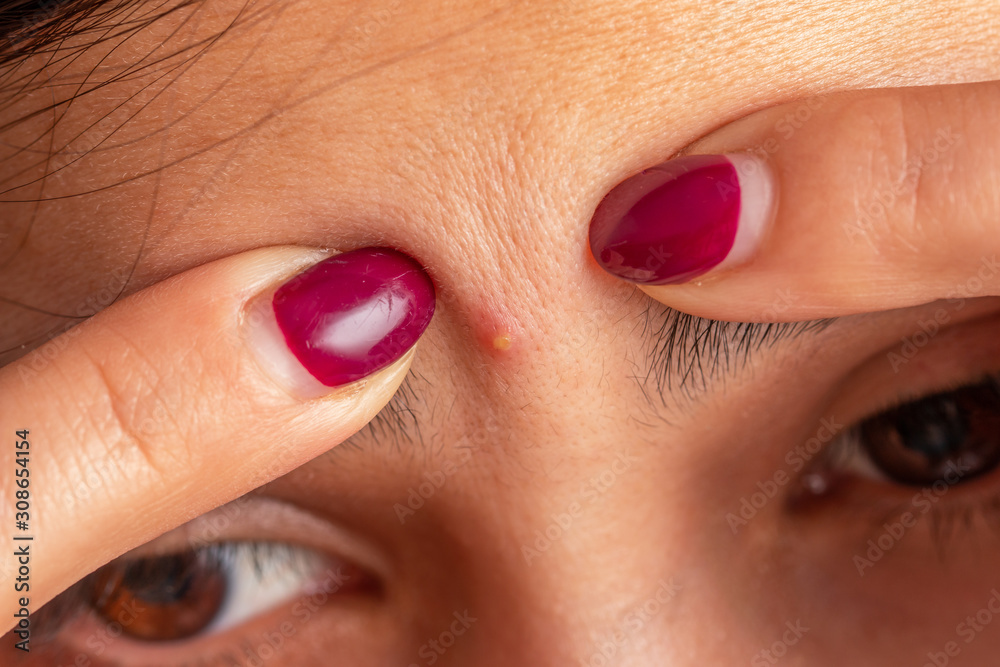 inflamed acne on the skin of the face Stock Photo | Adobe Stock