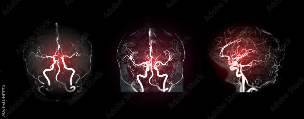 Collection of MRA brain or Magnetic resonance angiography image ( MRA ...