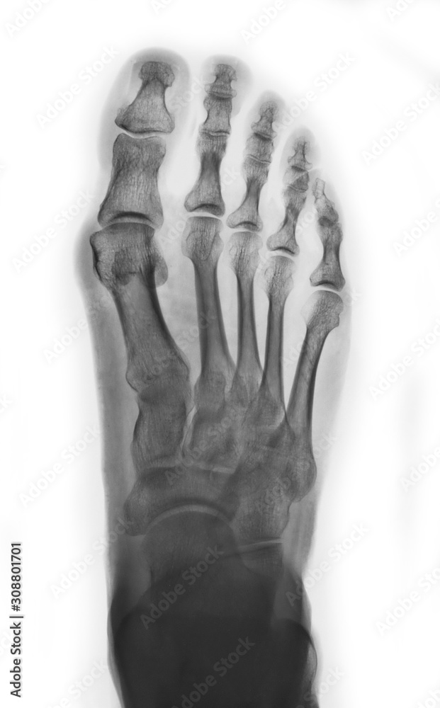 X-ray normal human foot . Top view . Stock Photo | Adobe Stock
