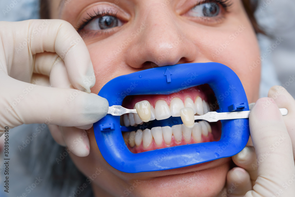 procedure for comparing the color shades of teeth with tests after ...