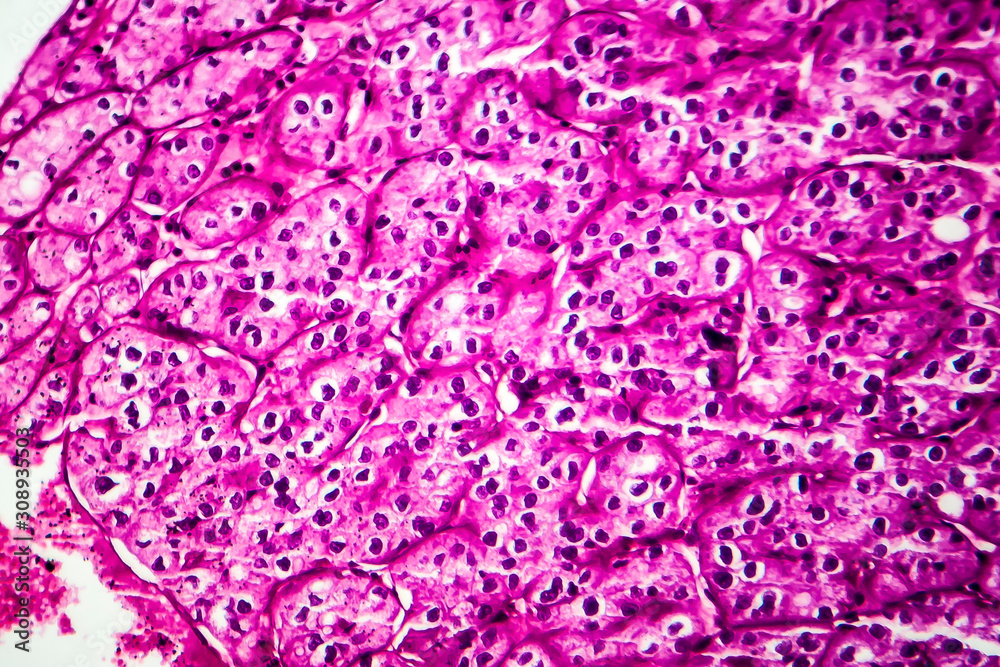 Kidney cancer, light micrograph, photo under microscope Stock Photo ...