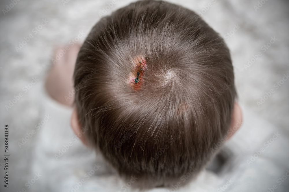 Foto Stock Head wound after a car accident. A fresh scar on the ...