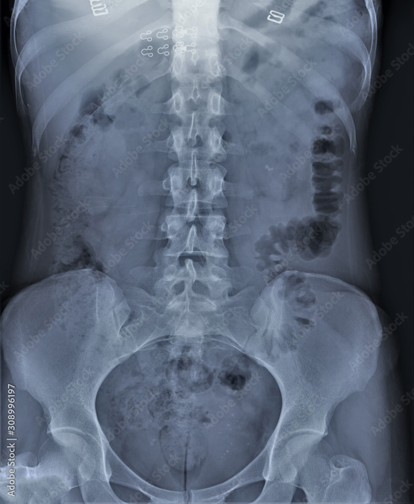x-ray of the abdominal cavity and pelvis in direct projection, medical ...