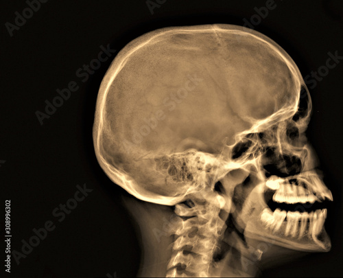 normal radiography of the skull in lateral projection in yellow medical ...