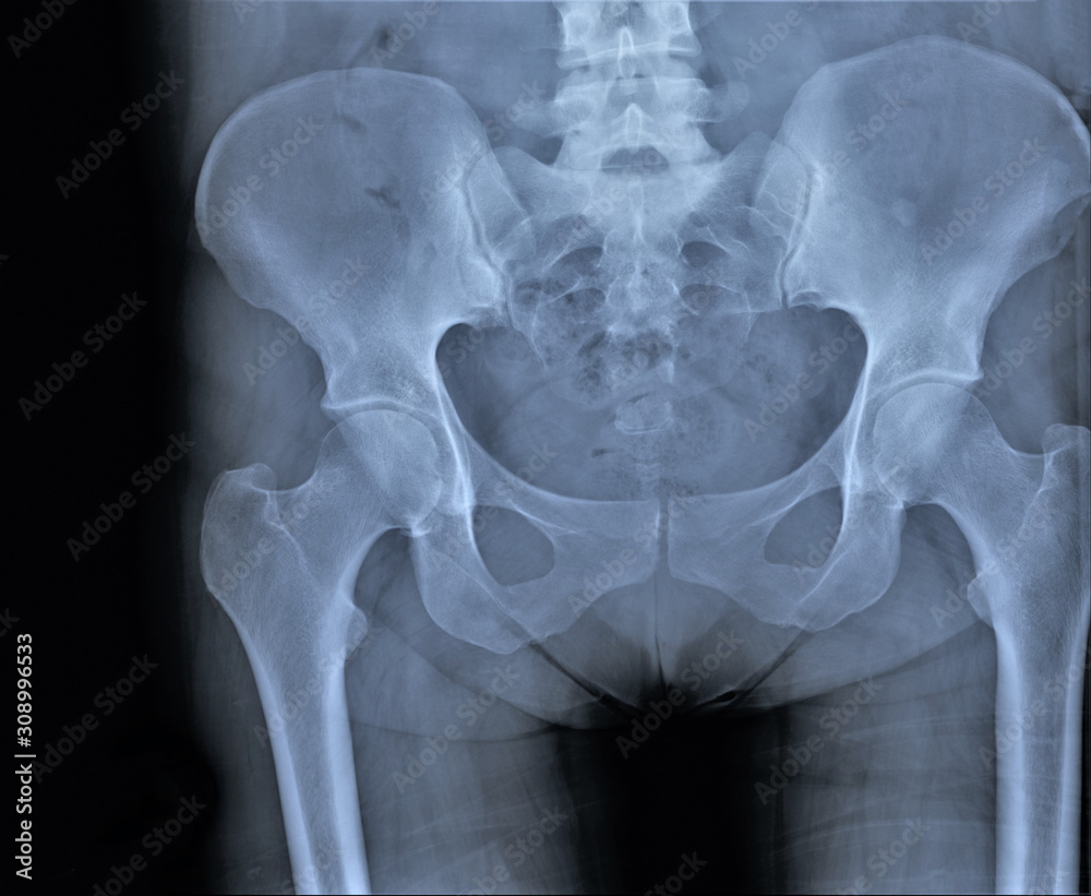 Osteoporotic Bone X Ray