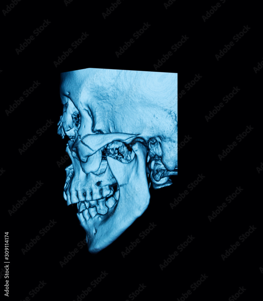 Computed tomography (CT scan) of facial bone, left obliqe view, showing ...