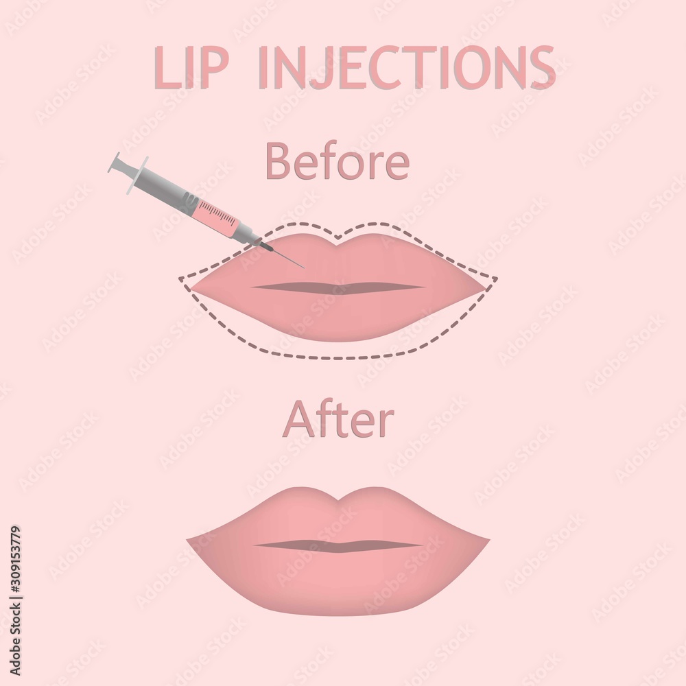 Vector image of lip injection before and after with syringe. Lip ...