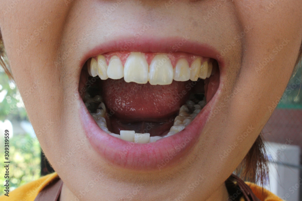 Asian woman's teeth aged 25-30 years, not scaled. Yellow teeth. Dental ...