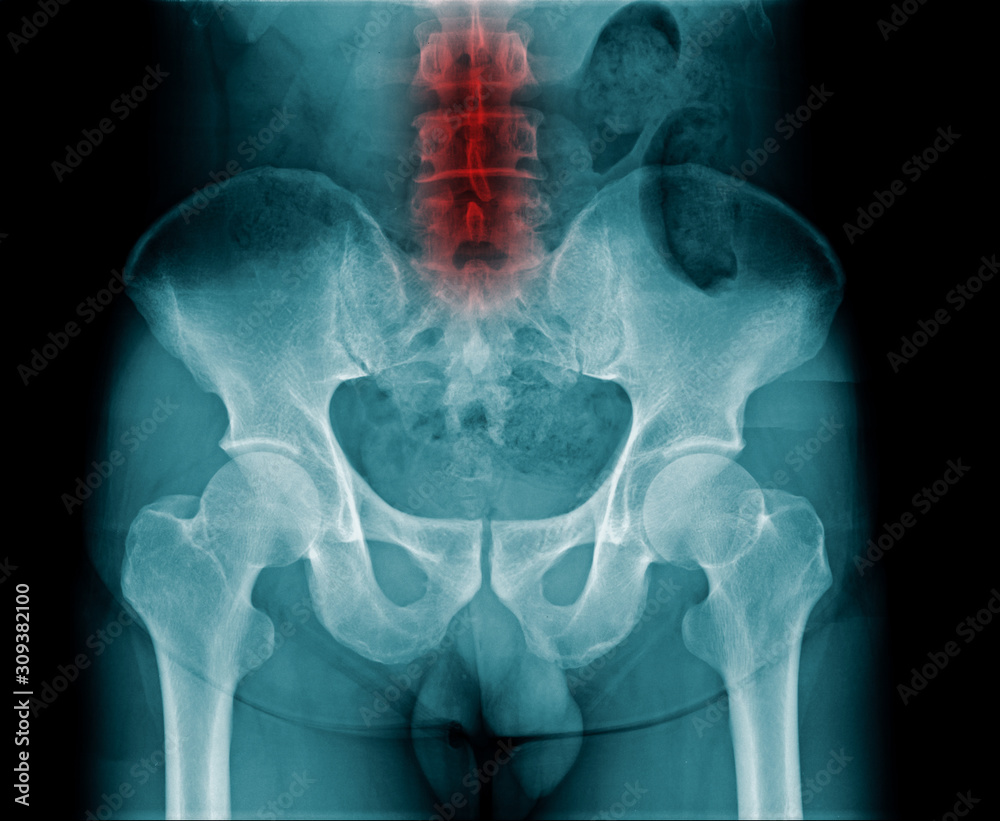 x-ray image of pelvic bone and part of lumbar spine Stock Photo | Adobe ...