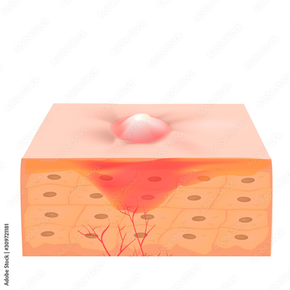 Vecteur Stock Inflamed acne on the skin. Inflamed pimple. The structure ...