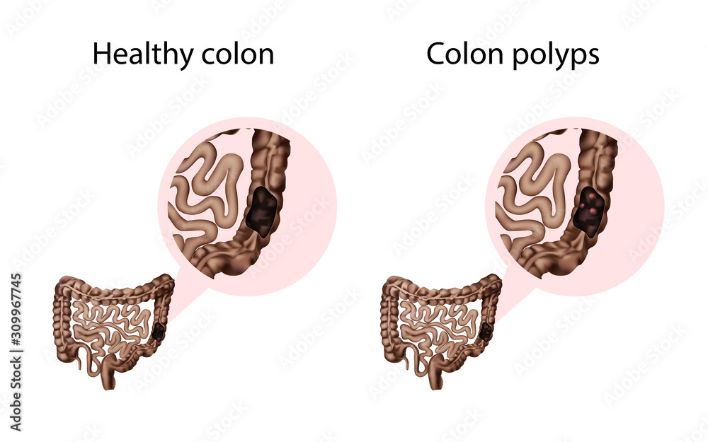 Colon polyps and healthy organ. Abnormal growth of tissue. Medical ...