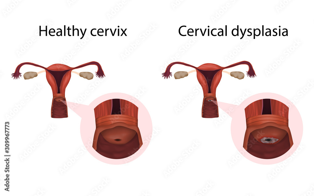 Cervix dysplasia and healthy organ. Cervical disease. Medical anatomy ...