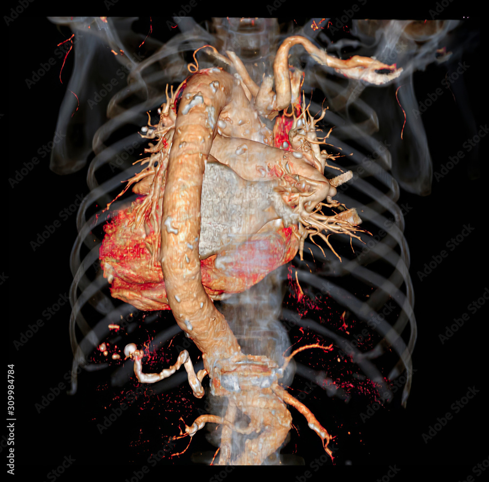 CTA thoracic aorta 3D rendering image posterior view or back view for ...