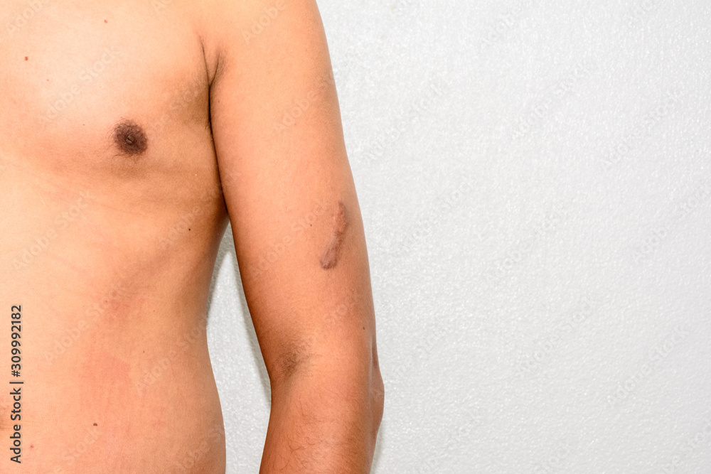 Scar on skin , Men don't wear clothes has Keloid on his arm. Isolated ...
