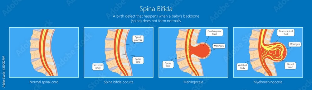 Spina bifida birth defects infant disease Stock Vector | Adobe Stock