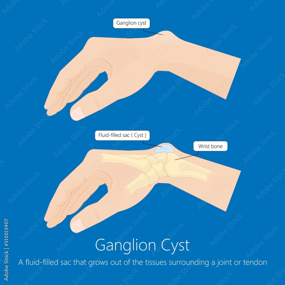 Ganglion cyst disease hand wrist trauma Stock Vector | Adobe Stock