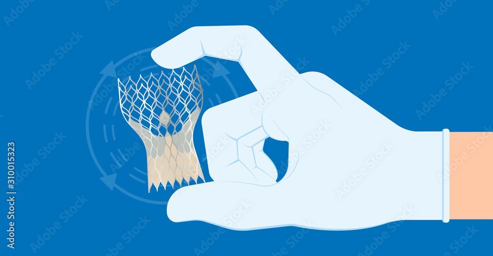 Transcatheter aortic valve replacement (TAVR) minimally invasive surgery Stock Vector | Adobe Stock