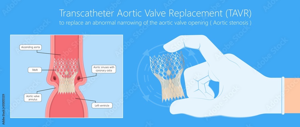 Poster Transcatheter aortic valve replacement (TAVR) minimally invasive ...