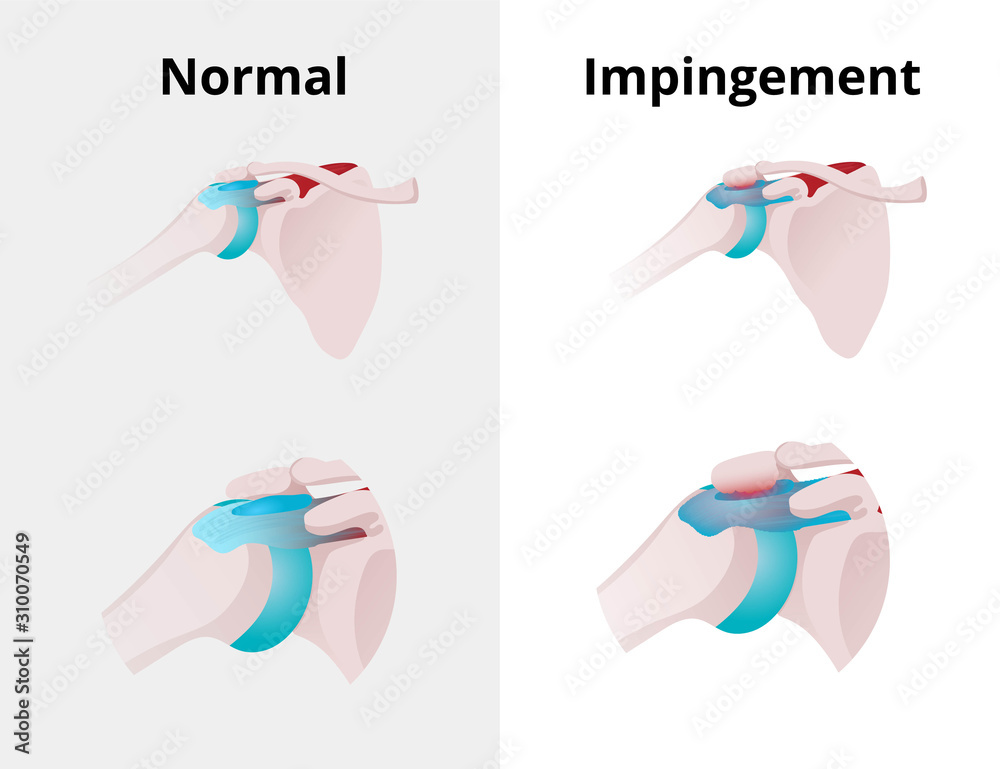 Normal shoulder and impingement. Illustration of the normal shoulder ...