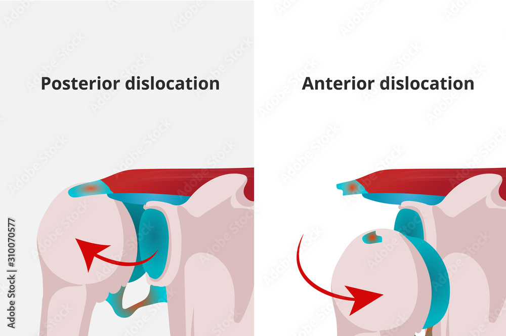 Anterior and posterior shoulder dislocation vector illustration Stock ...