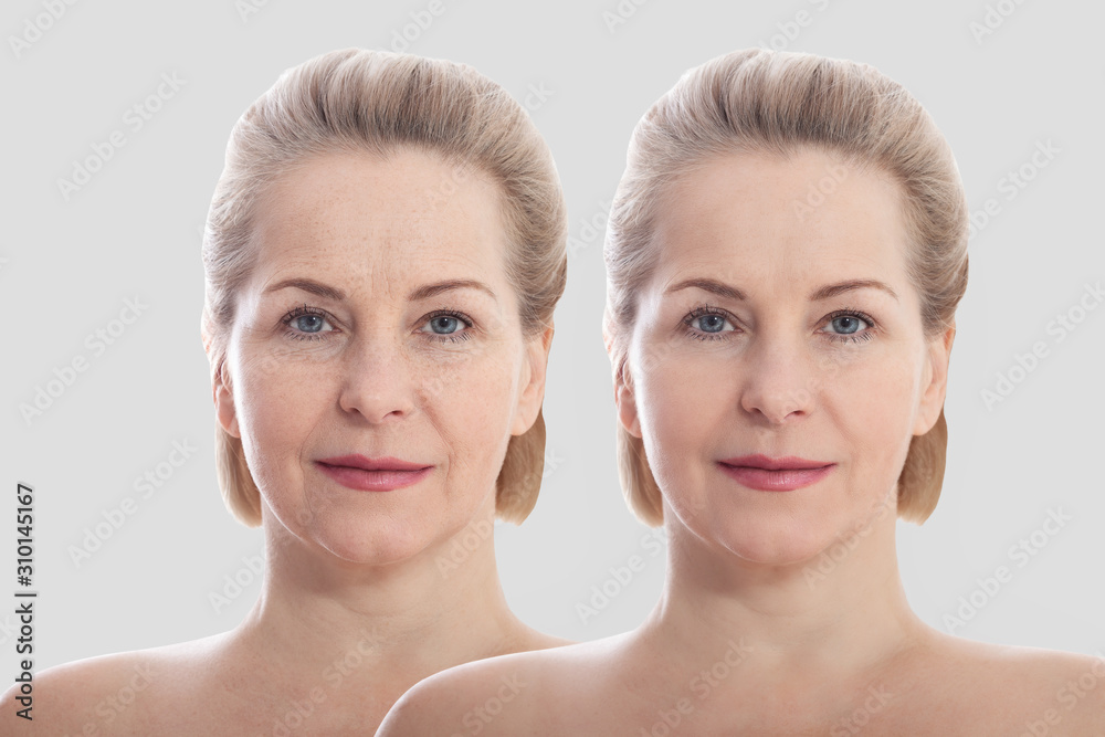 Middle age close up woman happy face before after cosmetic procedures ...