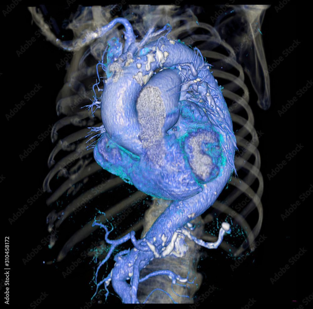 CTA thoracic aorta 3D rendering image for diagnotic abdominal aortic ...