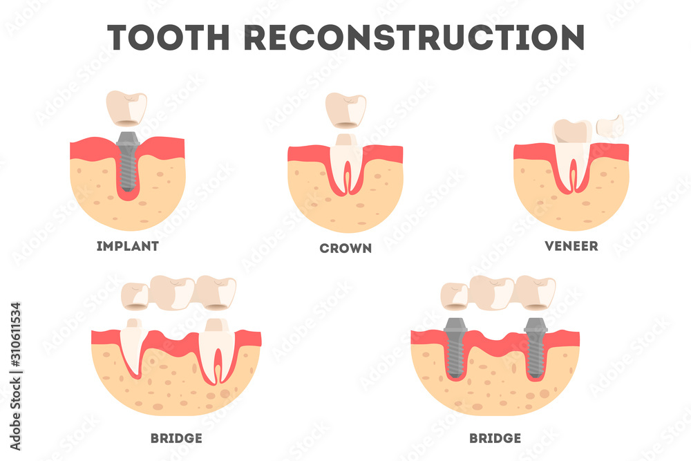 Set of diffrent human teeth reconstruction kind. Tooth loss and ...