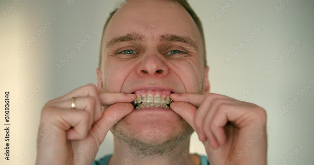 Close up of young man showing his braces and his teeth in slow motion ...