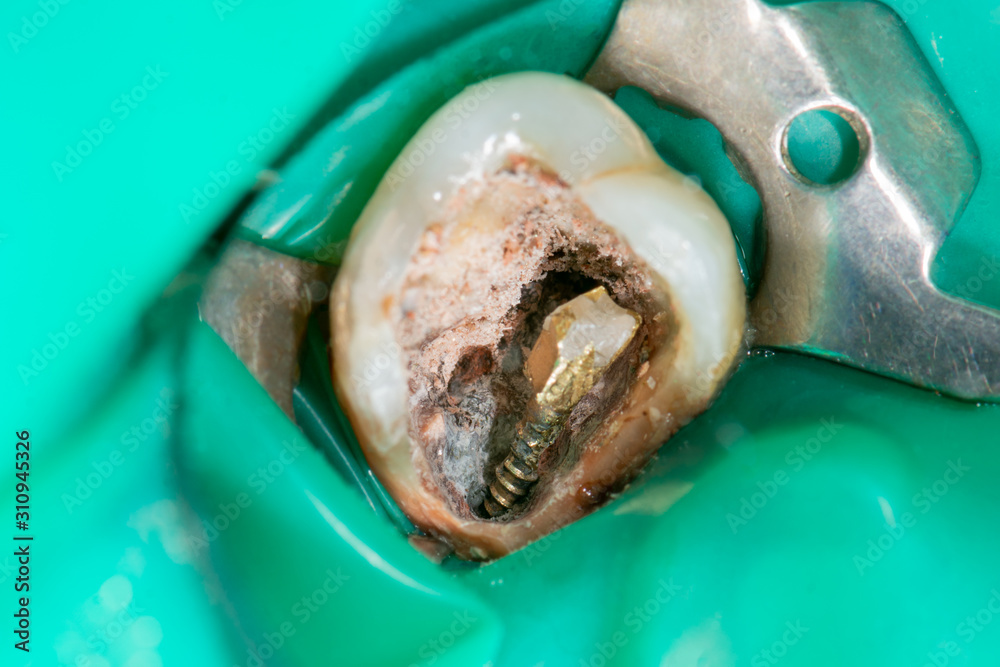 human tooth close-up macro. Endodontics treatment of canals and pulp of ...
