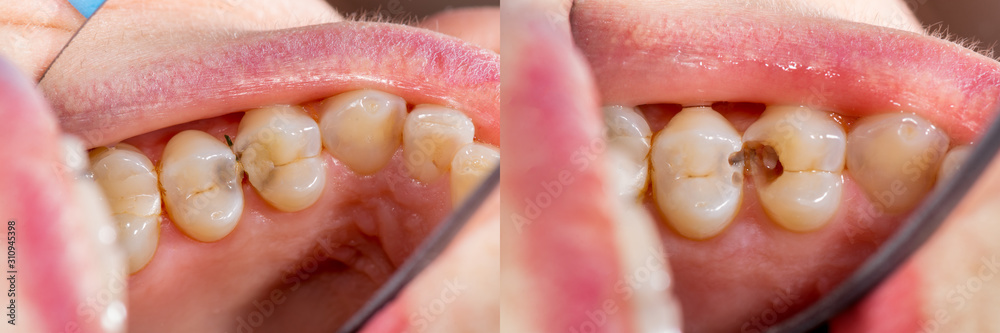 two chewing side teeth of the upper jaw after treatment of caries ...