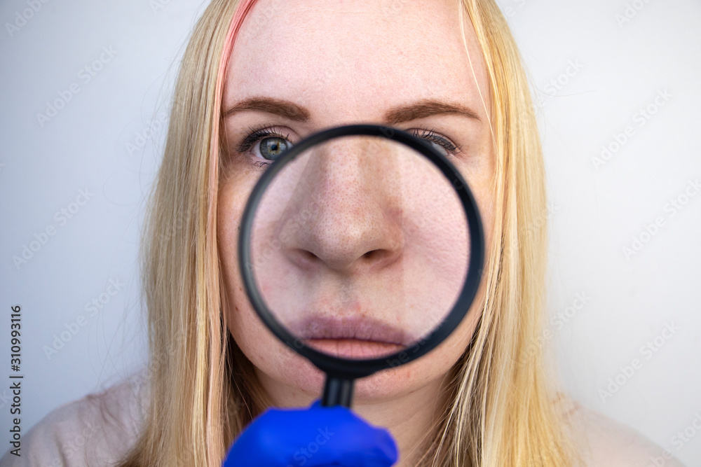 Expanded pores, black spots, acne, rosacea close-up on the nose. A ...