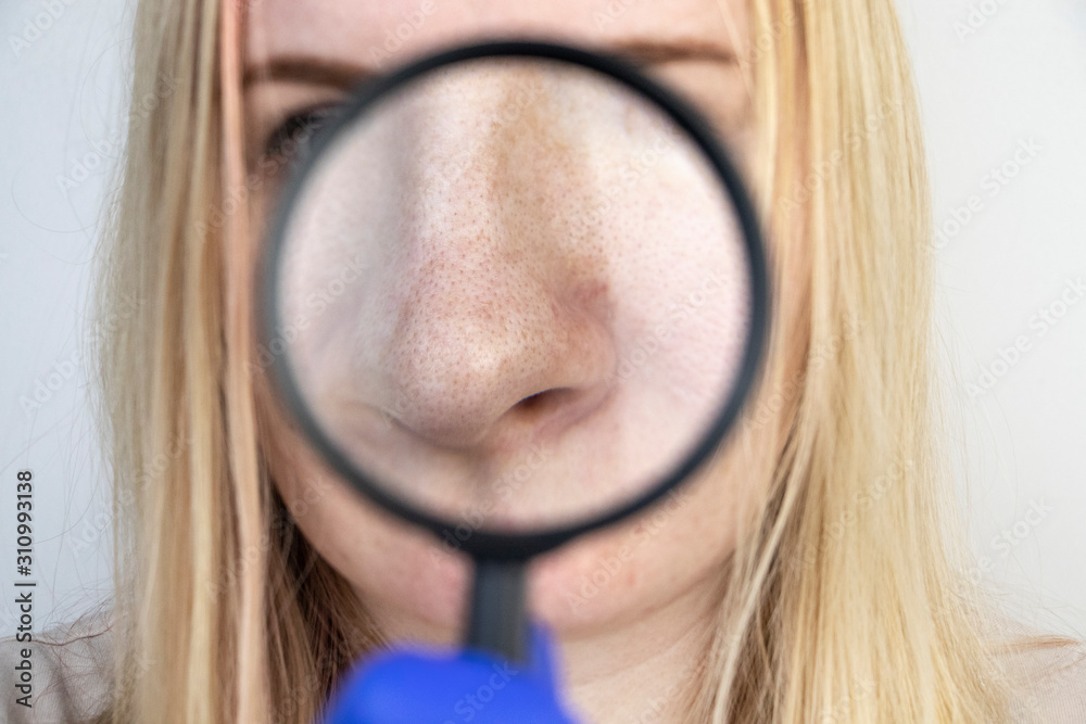 Expanded pores, black spots, acne, rosacea close-up on the nose. A ...