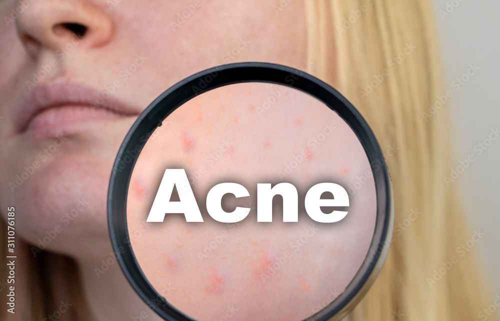 Acne close-up. A woman is being examined by a doctor. Dermatologist ...