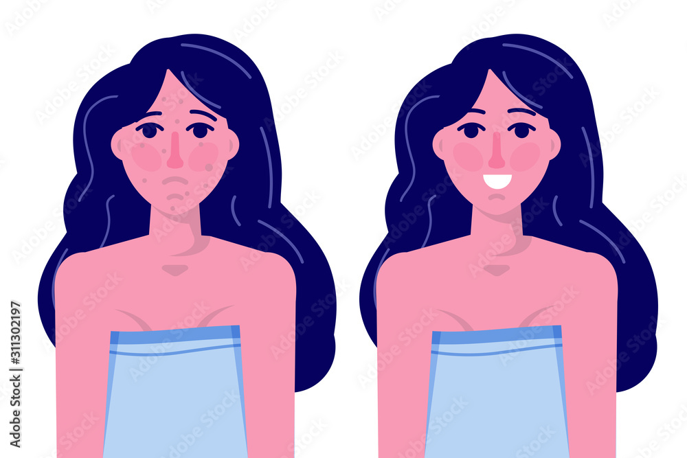 Laser or acid peeling, polishing before & after concept. Akne mark ...