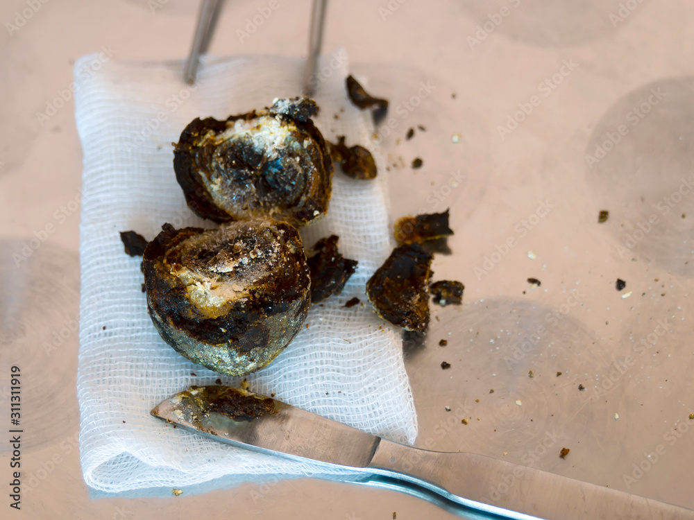 Large crystallized gallstone, cut when viewed. The concrement was ...