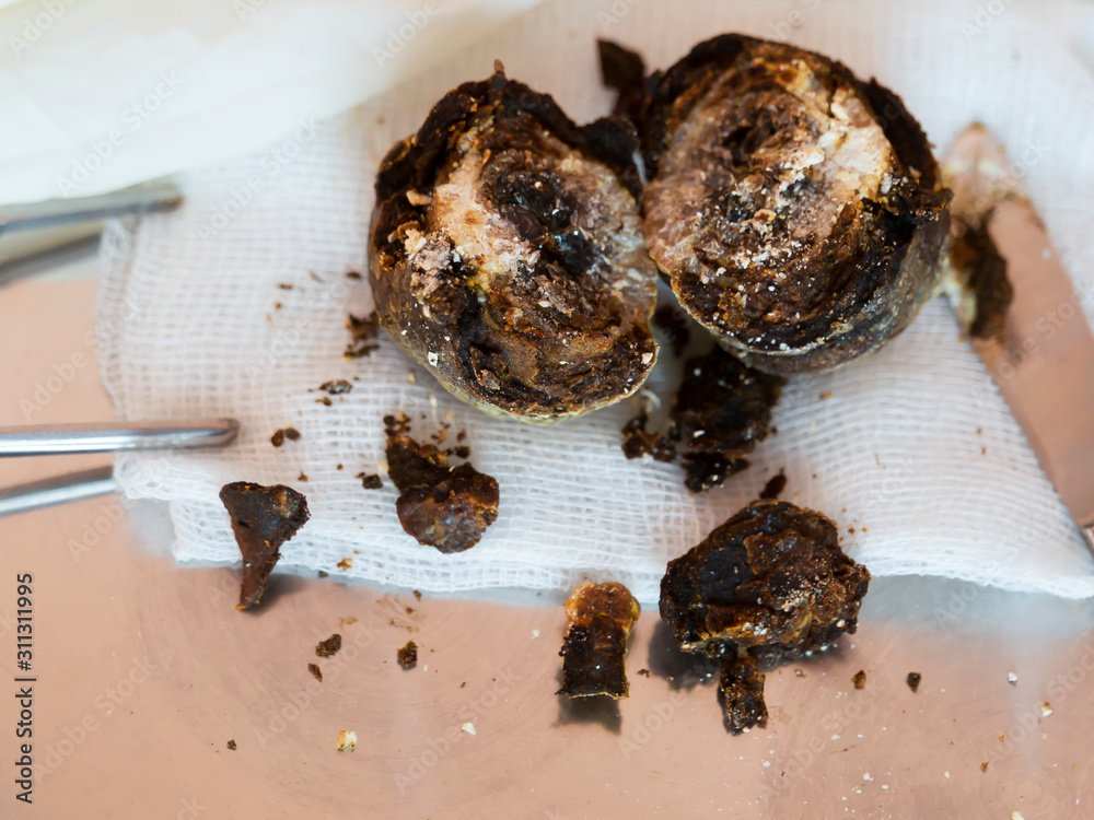 Large crystallized gallstone, cut when viewed. The concrement was ...