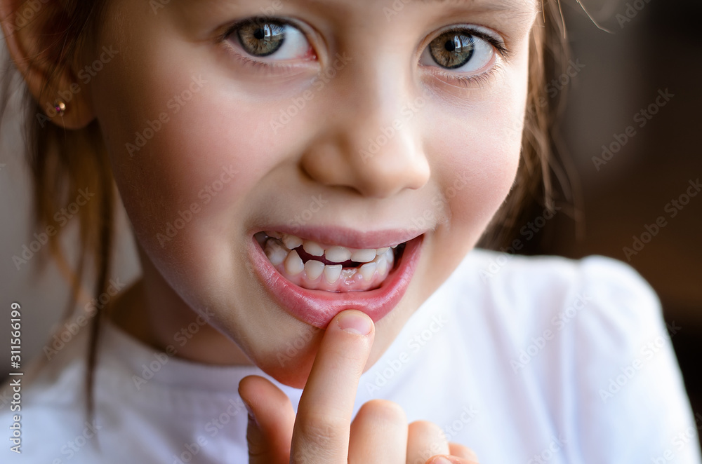 Beautiful smiling preschool girl with her first adult incisor tooth ...
