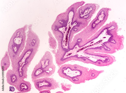 Squamous papillomas of the mouth and throat, including tongue, tonsil ...