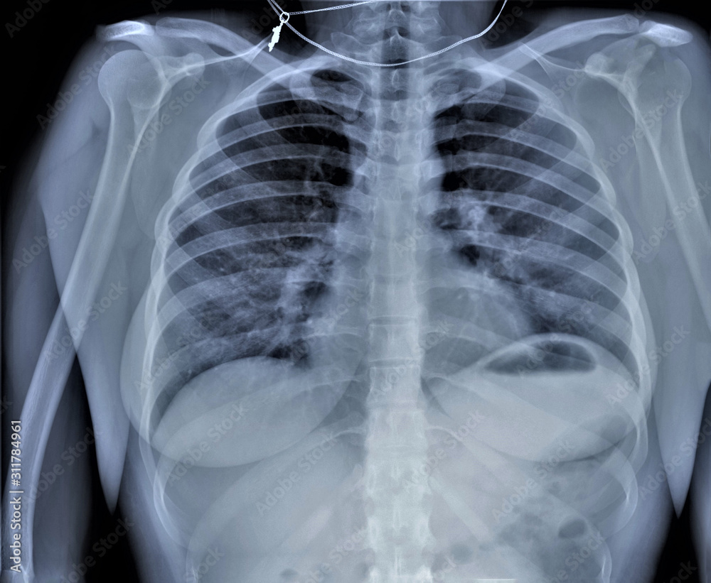normal radiography of chest organs in direct projection, traumatology ...