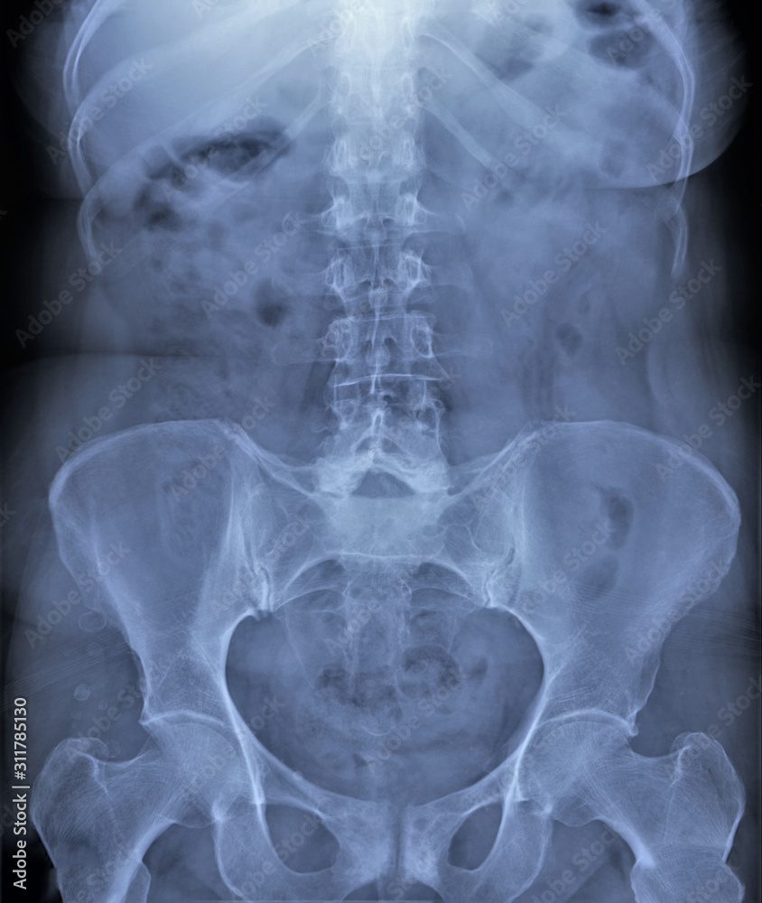 x-ray of the abdominal cavity and pelvis in direct projection, medical ...