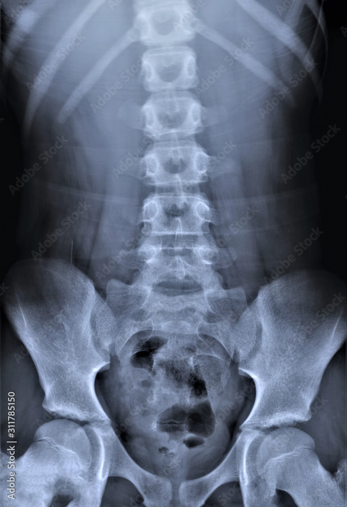 x-ray of the abdominal cavity and pelvis in direct projection, medical ...