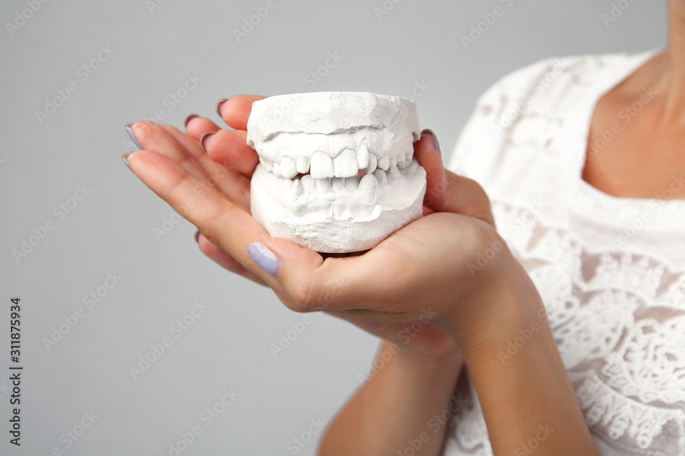Plaster cast of jaws. Dental casting gypsum model human jaws in ...