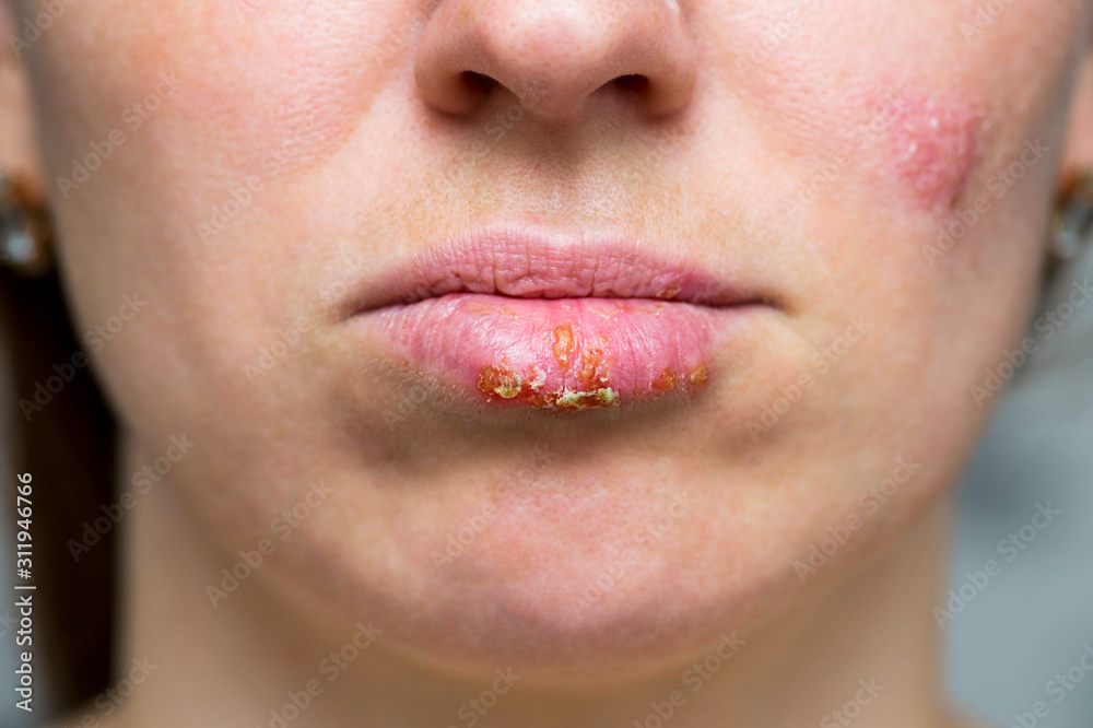 Closeup of a common cold sore virus herpes. Part of a young woman's ...
