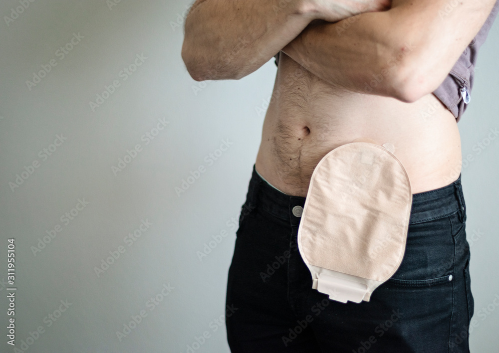 Front view on colostomy bag attached to man patient, medical theme ...