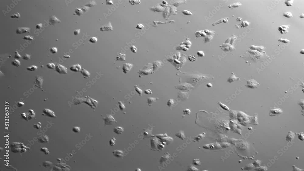 Human cancer cells. Movement, growth, and division of cancer cells in ...