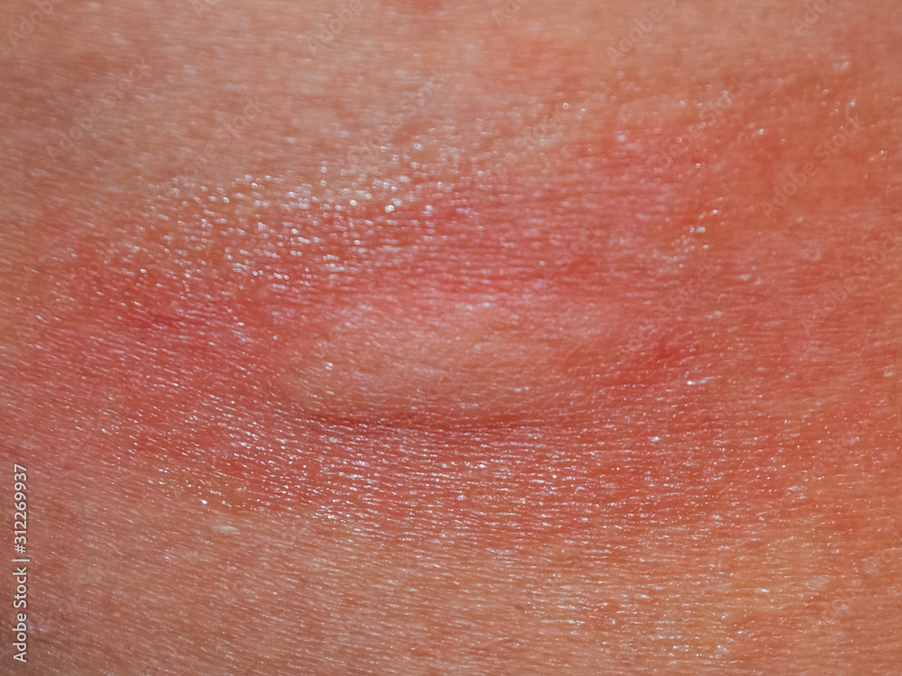 Allergy skin. Allergic reactions on the skin in the form of swelling ...