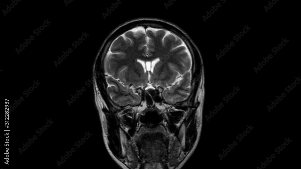 Brain MRI, head scans and tumor detection. Diagnostic medical tool ...