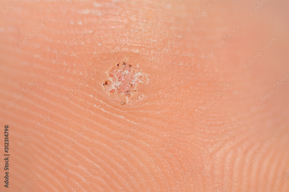 Close-up macro of a plantar wart on the bottom of a foot caused by the ...