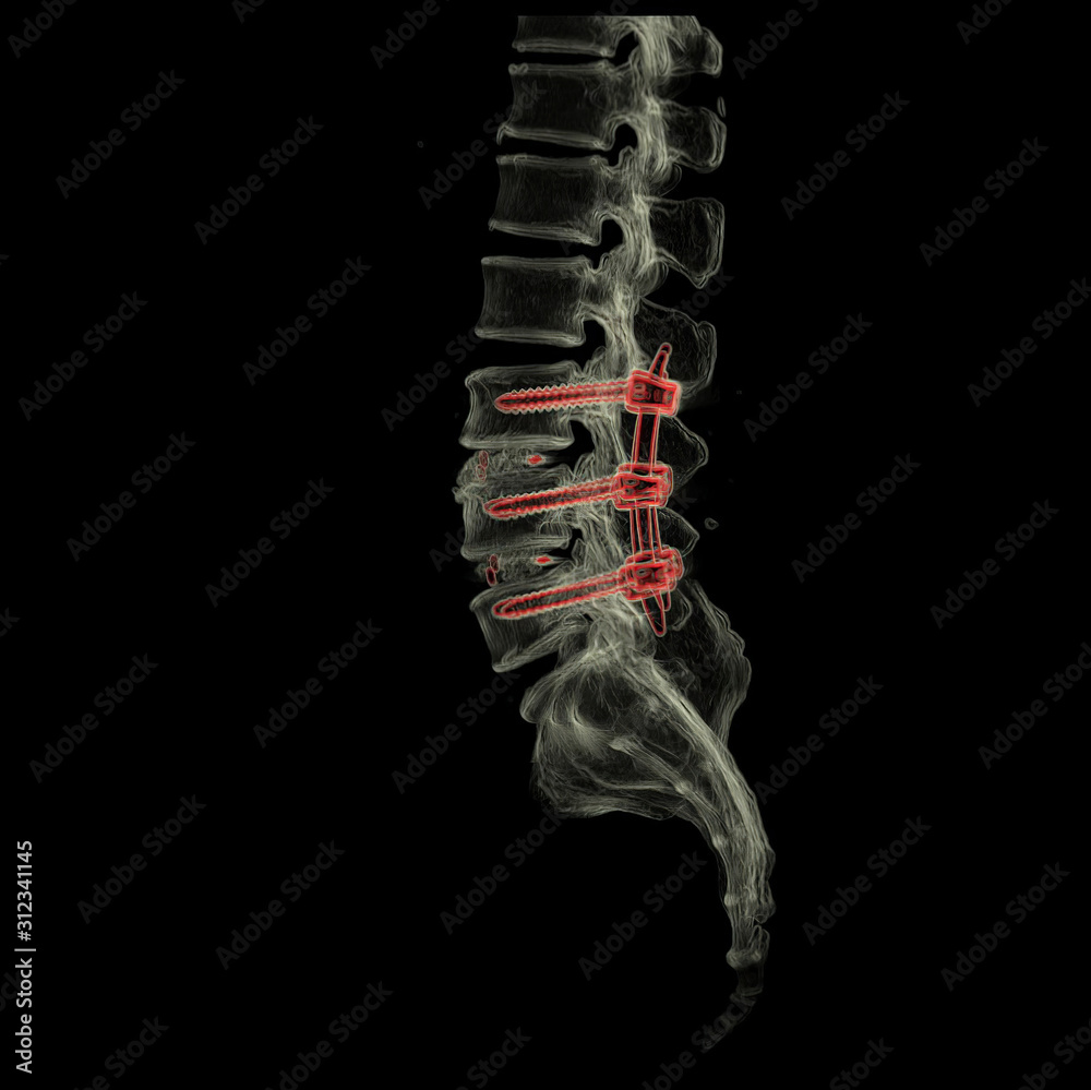3D computed tomography (CT) of L-S spine in lateral view with ...