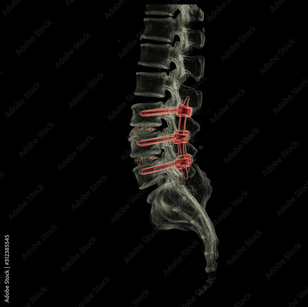 3D computed tomography (CT) of L-S spine in lateral view with ...